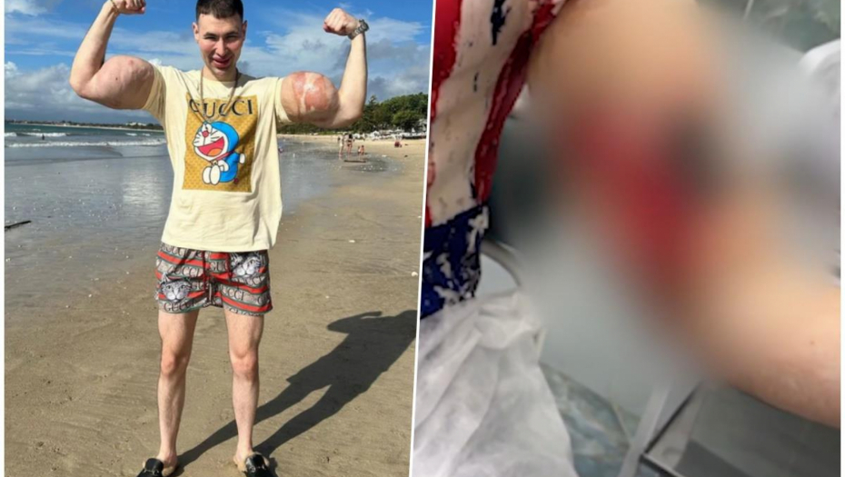 (UZNEMIRUJUĆE) POZNATOM INFLUENSERU PRETI AMPUTACIJA RUKU! Godinama ...